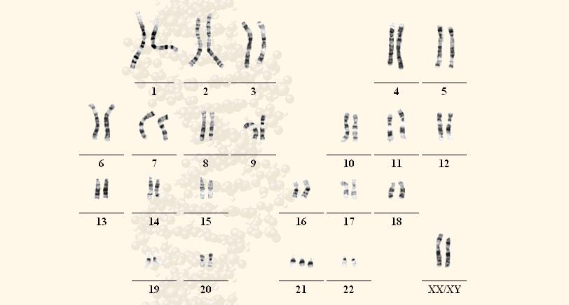 BIOMÈDICS GARBÍ: CASOS MÈDICS AMB CARIOTIPS