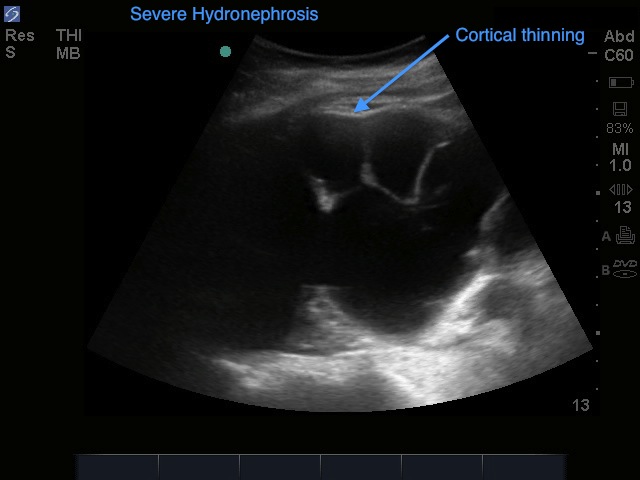 Hydronephrosis ~ Ultrasound Cases Info