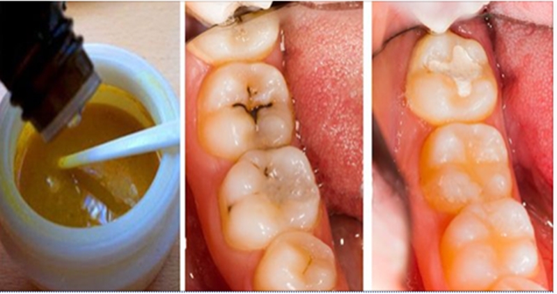 Kako izlečiti karijes ~ Recepti i Ideje