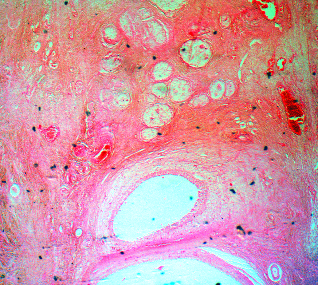 Sex Cord Stromal Tumor With Annular Tubules