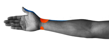 ARES Kinesiology Tape: Thumb Tendinitis
