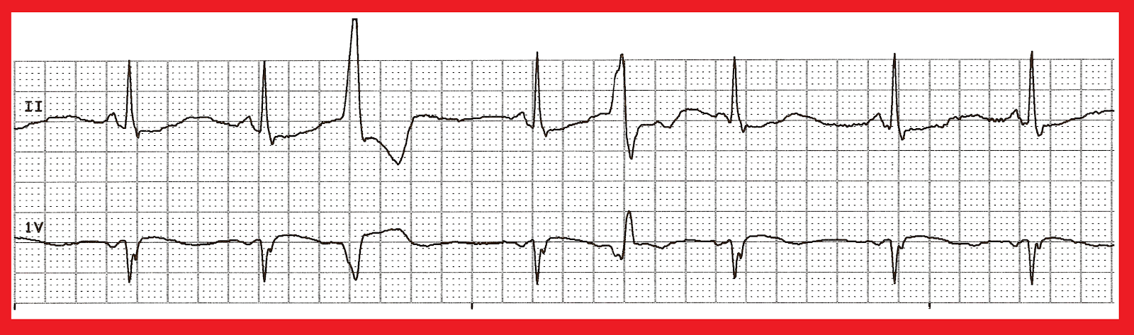 Float Nurse: EKG Rhythm Quiz 220
