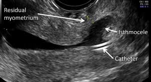 Ob/Gyn Updated : Hysteroscopic management of symptomatic cesarean scar ...