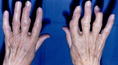 Cetah: Mano Reumática