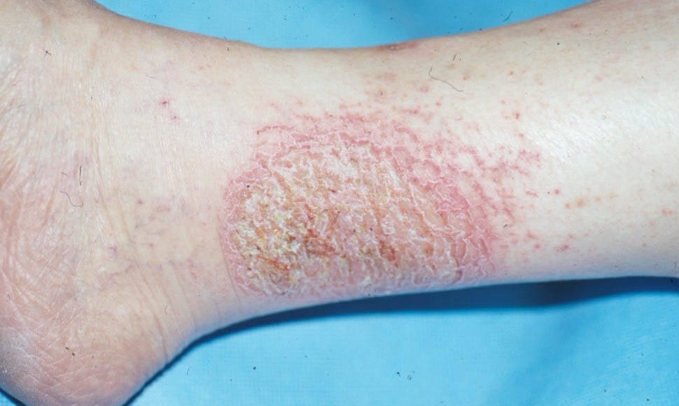 Eczema On Legs Cure