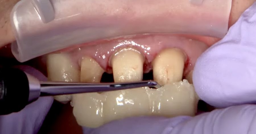 DENTAL MATERIALS: Fast Stent-Assisted Delivery of BioTemps® - Odonto-Tv