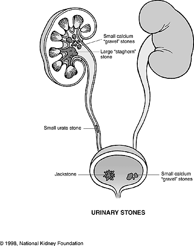Become a Homeopathy expert: Stone in the Urinary tract
