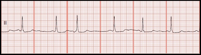 EKG Rhythm Strip Quiz 94: Ectopy and Escape Beats