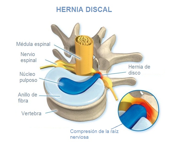 Fisioterapia: Las Hernias Discales