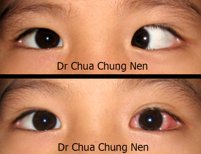 Eyelid Surgery by Prof Dr CN CHUA 蔡鐘能: Doc, Can You Straighten My Eyes ? IV