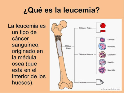 Introducción a la leucemia : ¿Que es la leucemia?
