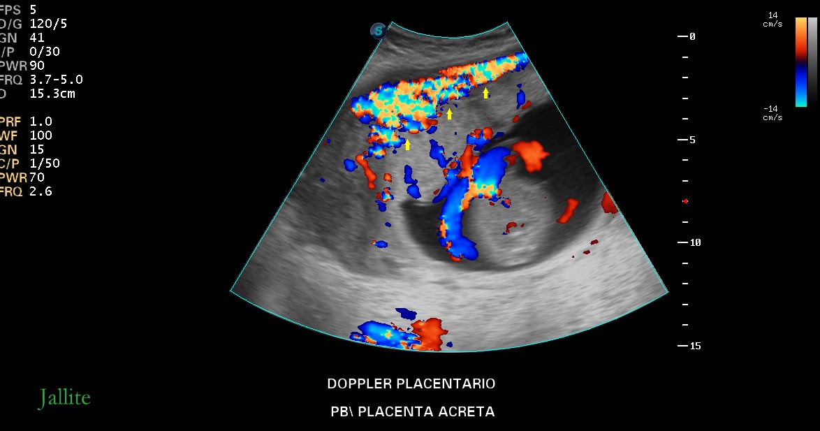 Placenta Increta Total
