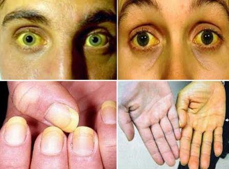 Ramuan Mujarab Ini Bisa Obati Sakit Kuning! BEGINI CARA Meraciknya ...