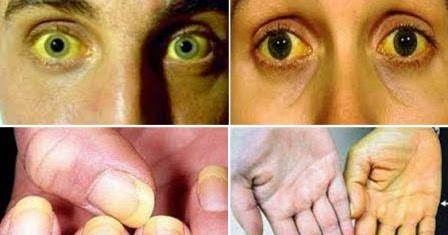 Ramuan Mujarab Ini Bisa Obati Sakit Kuning! BEGINI CARA Meraciknya ...