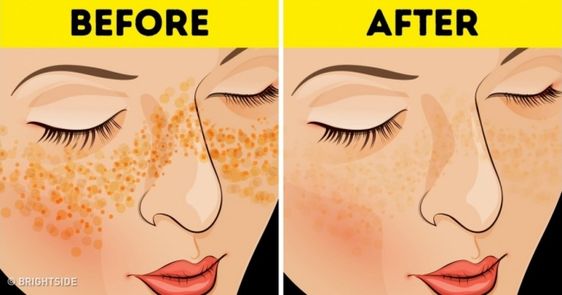 How to Get Rid Of Redness From Acne And Pimples