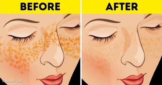 How to Get Rid Of Redness From Acne And Pimples