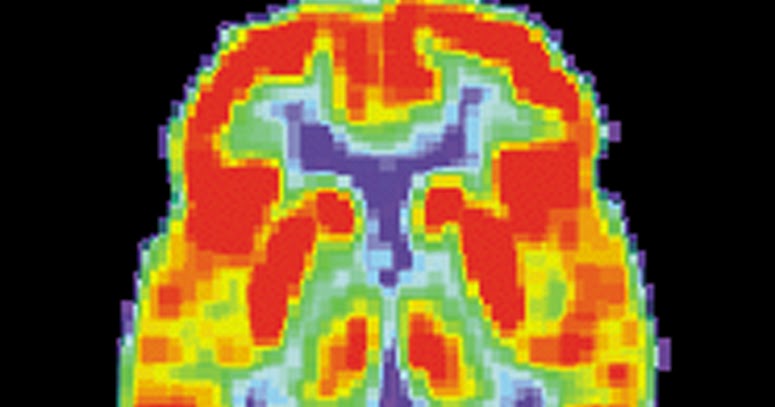 Brain Thermography: brain thermography