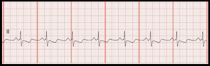 EKG Rhythm Strip Quiz 138