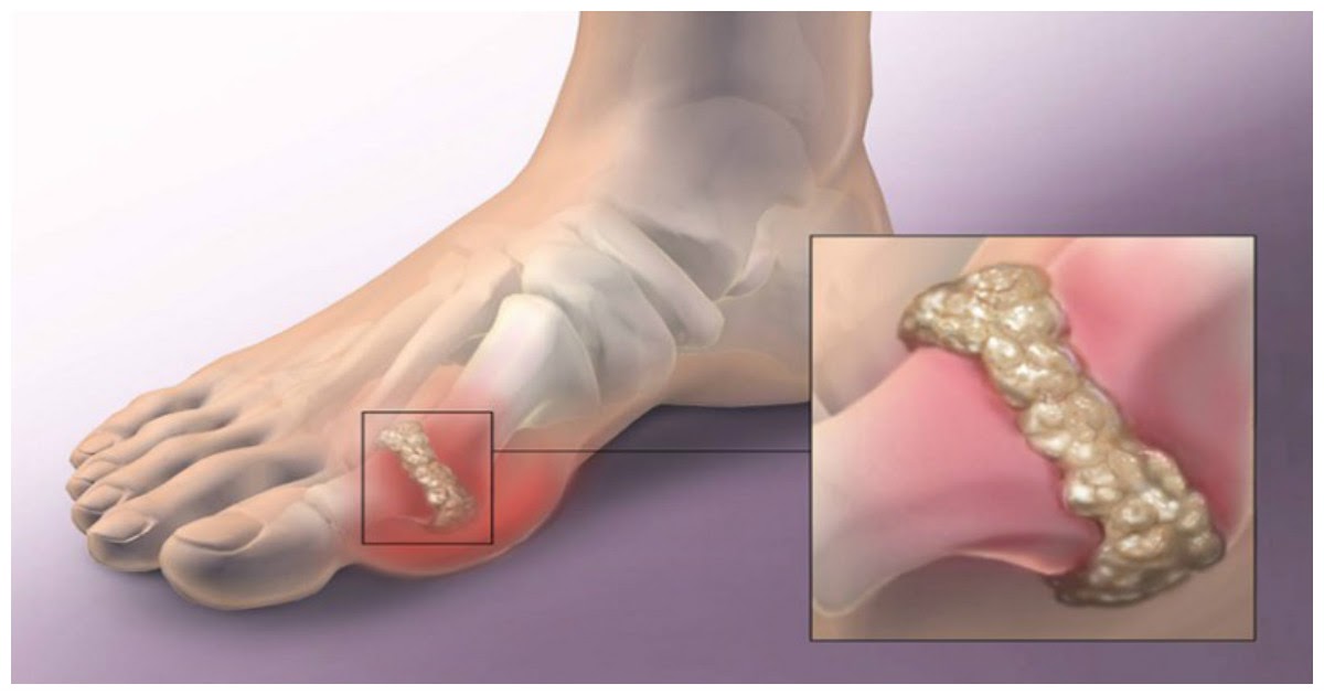 How To Quickly Remove Uric Acid Crystalization From Your Body To ...