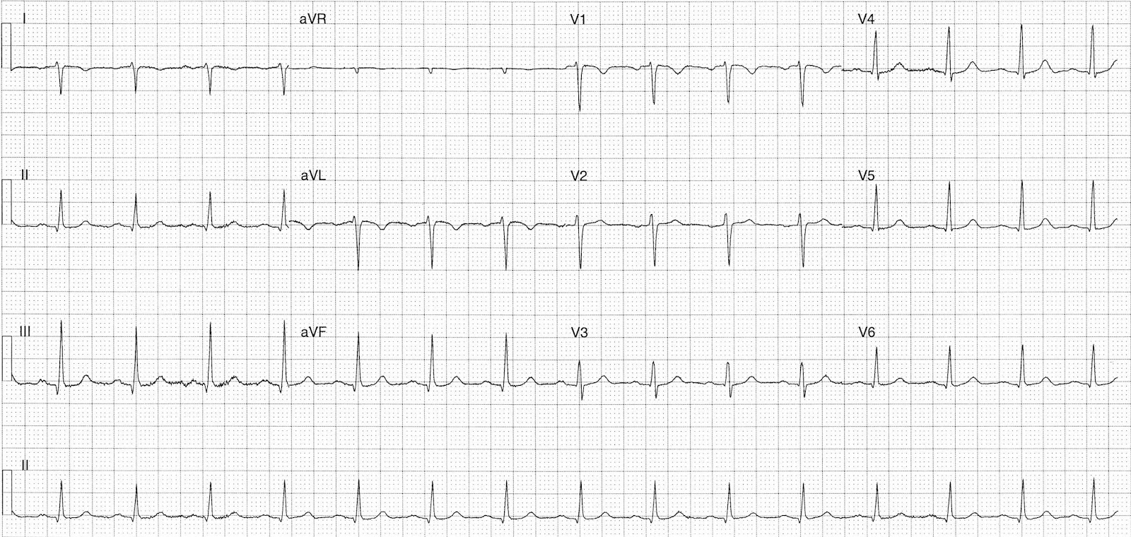 ECG of the Week: ECG of the Week - 28th November 2016