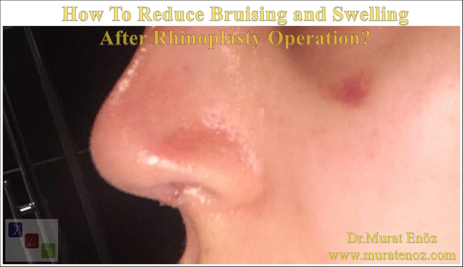 Rhinoplasty Recovery Guide 👃 - 46 - How To Reduce Bruising and Swelling ...