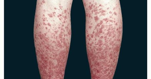 BLOG ENCONTRO COM A SAÚDE DE SOBRAL: Vasculites