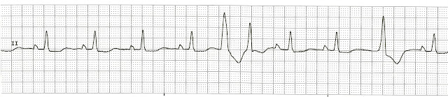 ECG Rhythm Strips 80