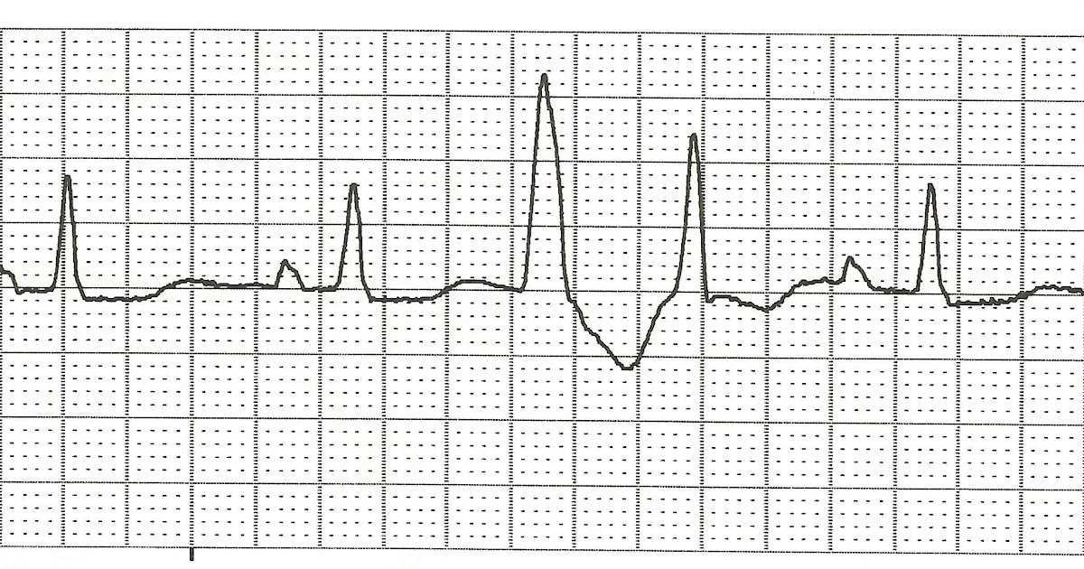 ECG Rhythm Strips 80