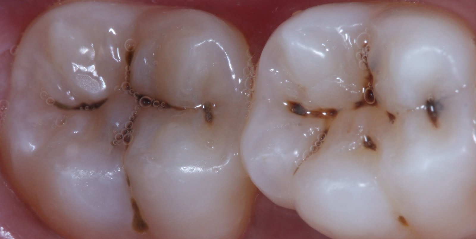 Cárie: O que é cárie