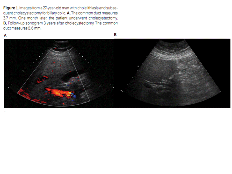 BÀI SOẠN VỀ SIÊU ÂM CHẨN ĐOÁN: CBD Dilatation