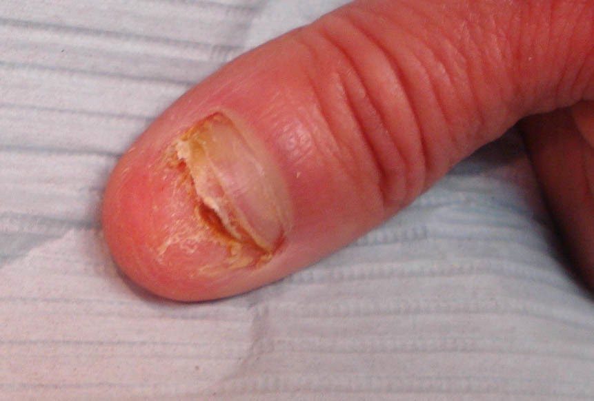 VIRTUAL GRAND ROUNDS IN DERMATOLOGY 2.0: A Nail Struggle