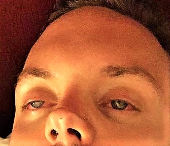 OJO ALÉRGICO, SECO GRAVE Y SJÖGREN: OJO SECO: LAGOFTALMOS