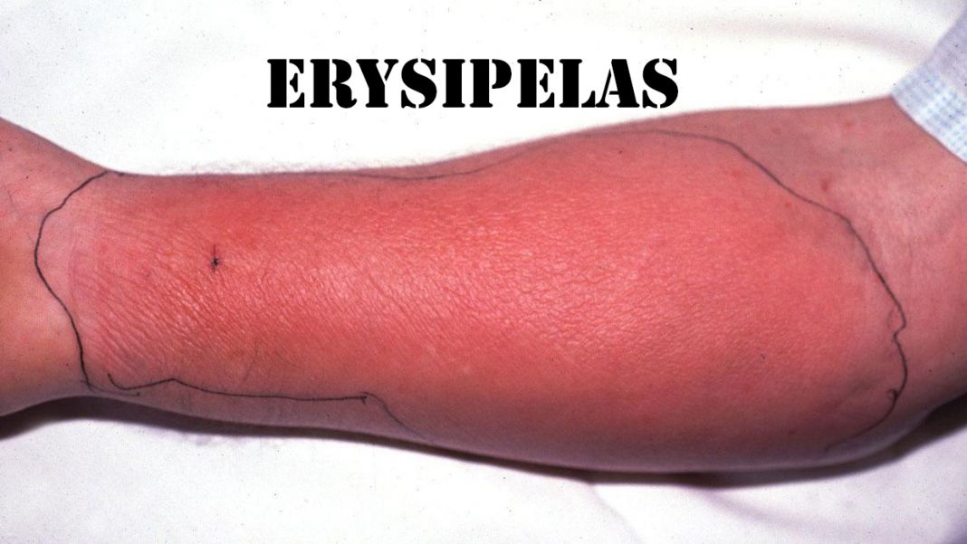ERYSIPELAS : DEFINITION ,CLINICAL FEATURES & COMPLICATIONS - Humainology