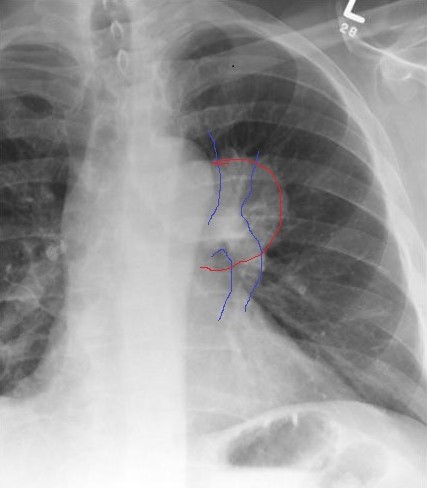 Chest Medicine Made Easy-Dr Deepu: Signs in chest radiology- The hilum ...