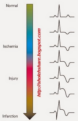 ST Elevasi Miokard Infark (STEMI) pada EKG | SholehShare