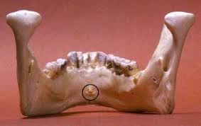 Medical Treatment Pictures-for Better Understanding: Mylohyoid Ridge ...