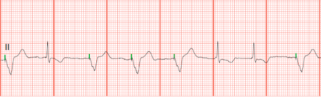 Float Nurse: Basic EKG Rhythm Test 45