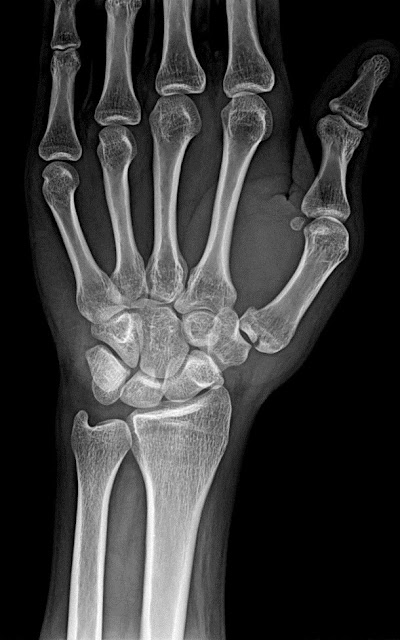 Radshare: BENNETT'S fracture