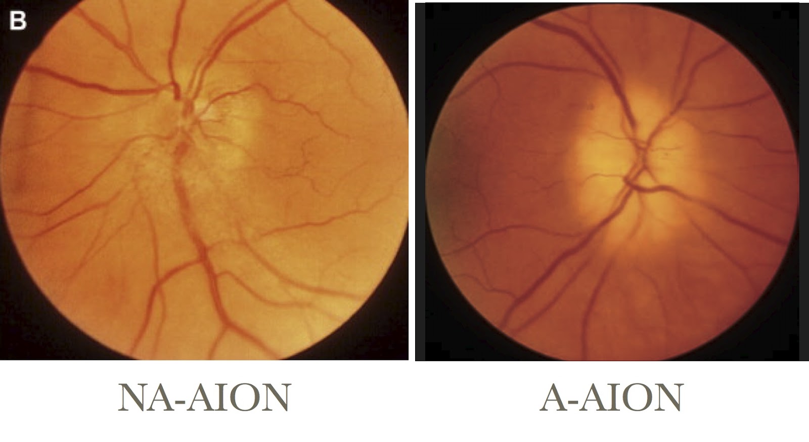 Hospitalist ~なんでも無い科医の勉強ノート~: 虚血性視神経症(Ischemic Optic Neuropathy)