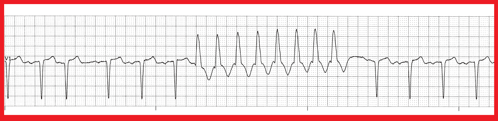 EKG Rhythm Quiz 234