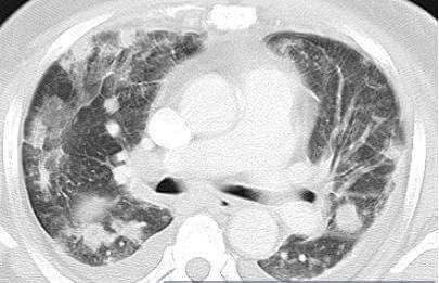 Chest Medicine Made Easy-Dr Deepu: Septic Pulmonary Embolism