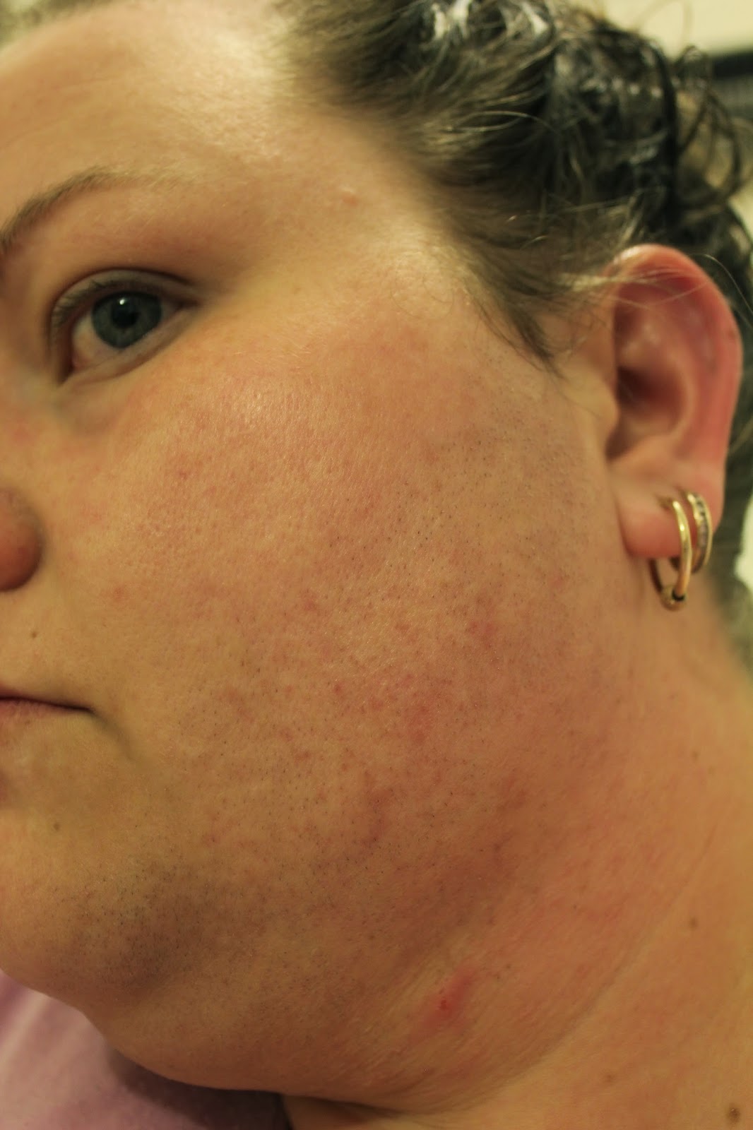 PCOS: My IPL Experience Against Hirsutism : September 2013