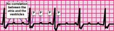 3 AV Block (Complete Heart Block) ~ Nursing