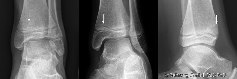 Roentgen Ray Reader: Kump's Hump