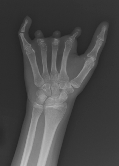 Toe Transfers | Congenital Hand and Arm Differences | Washington ...