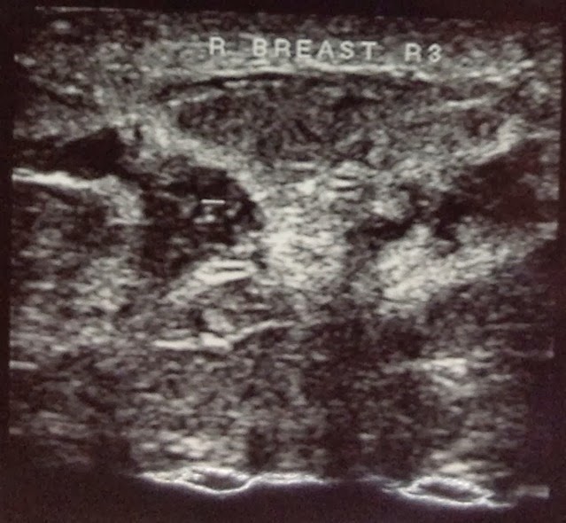 AUTOVACUNAS: Mastitis Infecciosa