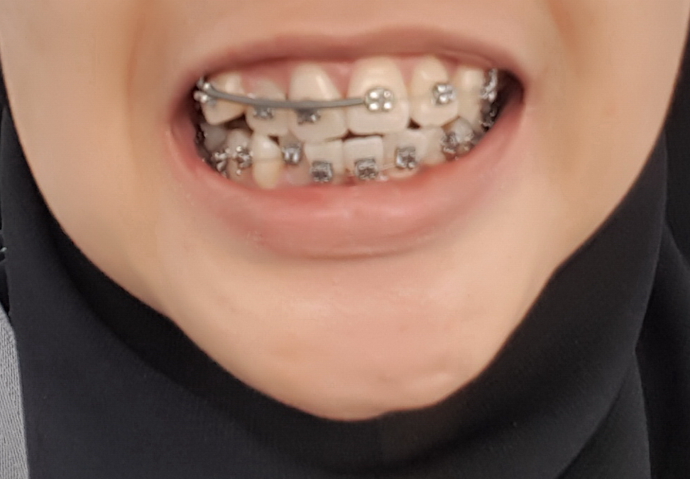 nanyfadhly: Braces Story Updated! Part 2