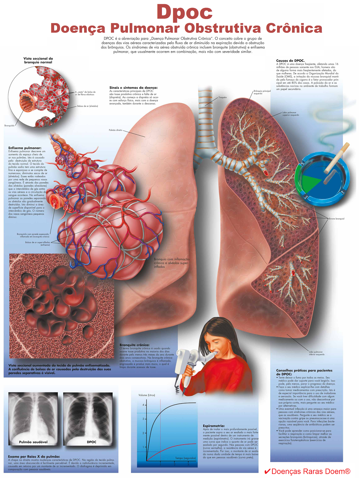 Doenças Raras Doem®: O que é a Dpoc - Doença Pulmonar Obstrutiva Crônica?