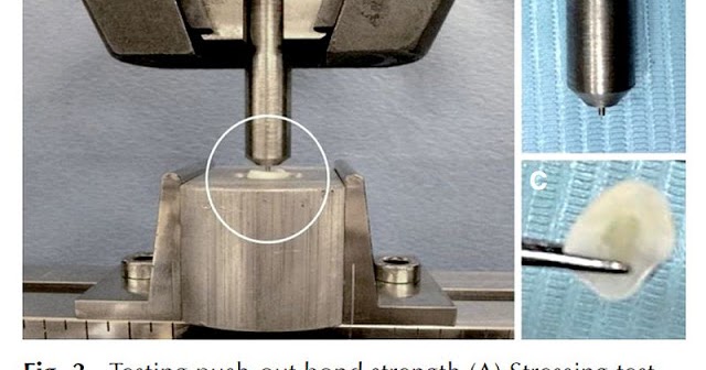 PDF: Bonding values of two contemporary ceramic inlay materials to ...