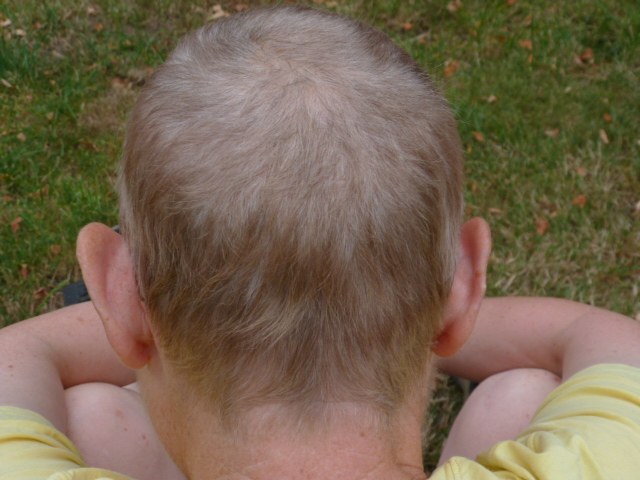 The adventures of a person with eclectic interests: Chemo hair regrowth